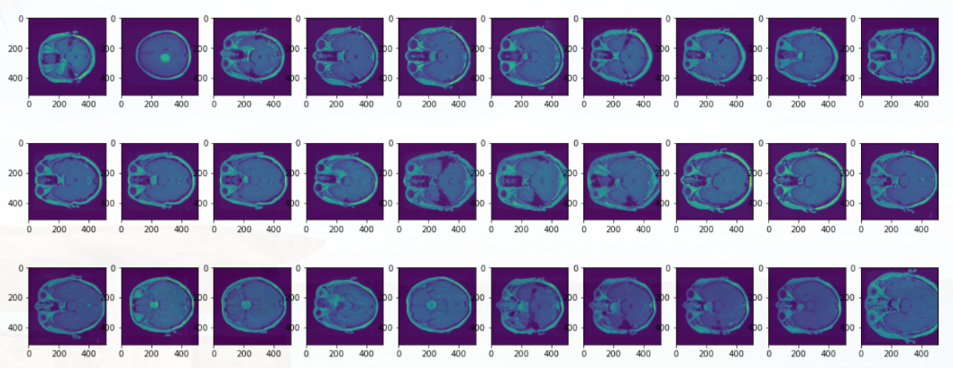 Brain Tumor Classification